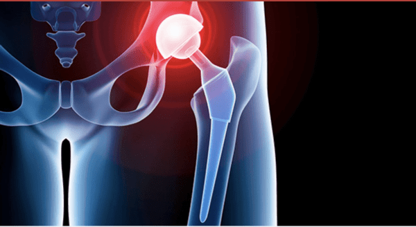 Exactech Expands Orthopedic Hip Implant Recall | Jenner Law